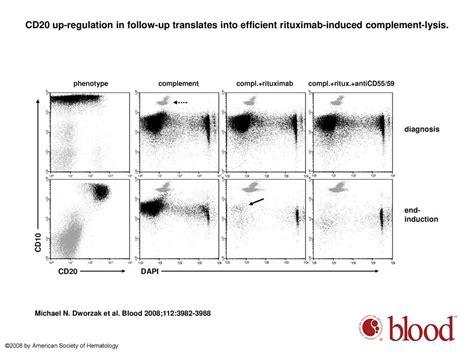 Cd20 Up Regulation In Pediatric B Cell Precursor Acute Lymphoblastic
