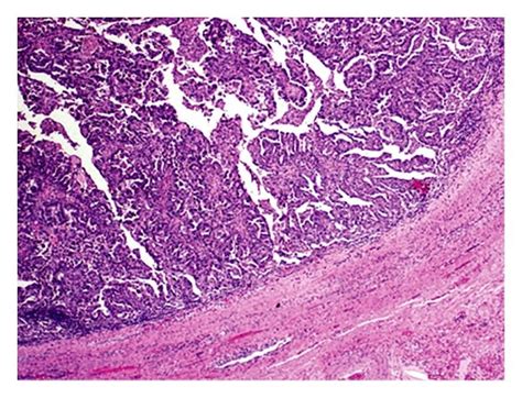 A Is The Macroscopic Image Of The Left Fallopian Tube Which Shows A