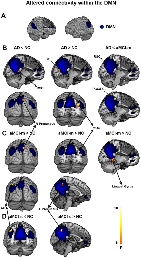Dysfunctional Interactions Between The Default Mode Network And The