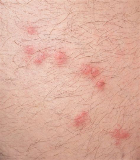 7 Common Bug Bites And How To Identify Them David Avocado Wolfe