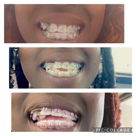 4 Month Progress Top Pic Was June 21 Bottom Pic Is Now Such A Big