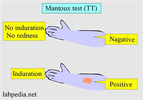 Mycobacterium Tuberculosis Part Mantoux Test Tt 60 Off