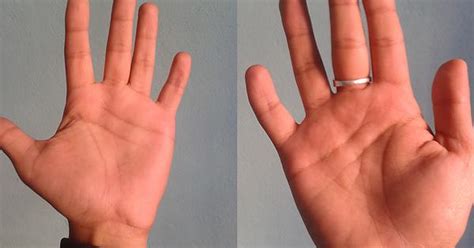 both of my pinky has single partition imgur