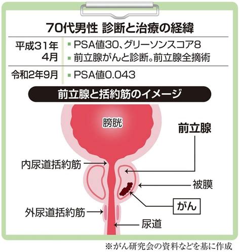 【がん相談から】前立腺全摘出後、放射線治療を提示された（1 2ページ） 産経ニュース