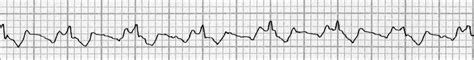 tachycardia 2017 10 20 ahc media continuing medical education