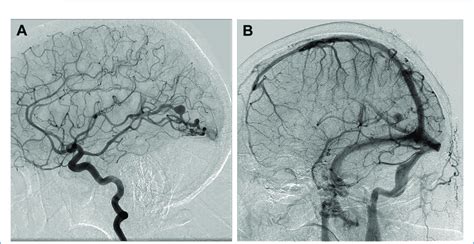 A Lateral Projection Arterial Phase Digital Subtraction Angiography
