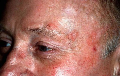 Seborrheic Keratosis Causes Symptoms Home Treatment