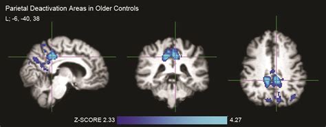 Functional Mri In Alzheimers Disease Intechopen