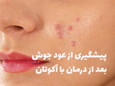 چگونه از عود جوش بعد از درمان با آکوتان جلوگیری کنیم ؟ آکنه یار درمان