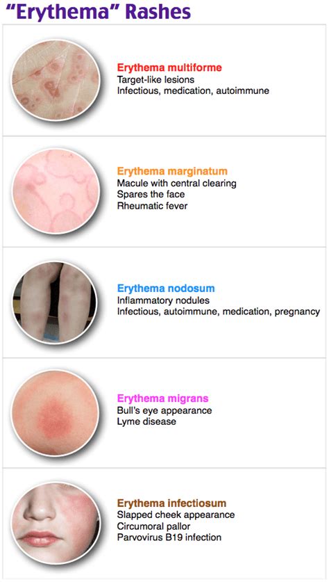 Erythema Chronicum Migrans Vs Erythema Multiforme
