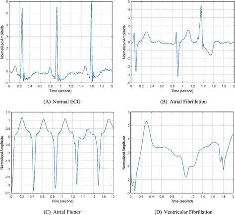 Display Of Two Second Segments Of Different Types Of Arrhythmias On An