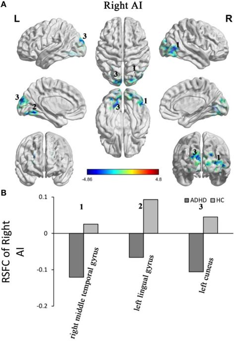 Abnormal Resting State Functional Connectivity Of Insular Subregions