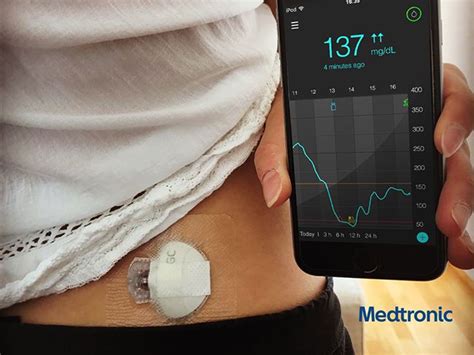 Review Del Guardian Connect Sistema De Medición Continua De Medtronic