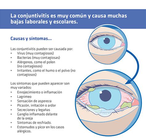 Como Se Cura La Conjuntivitis En Los Ojos Consejos Ojos