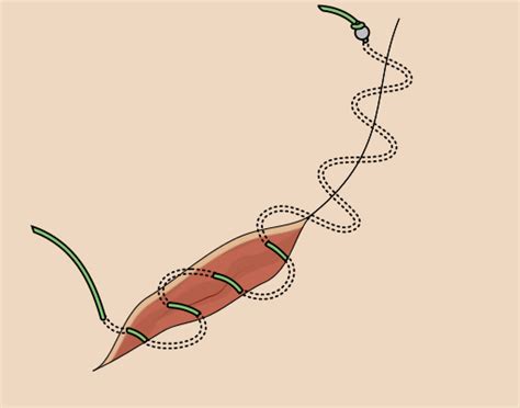 Running Subcuticular Suturing Epomedicine