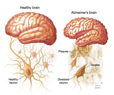 Alzheimers Disease Causes Symptoms Treatments And Nursing Care For