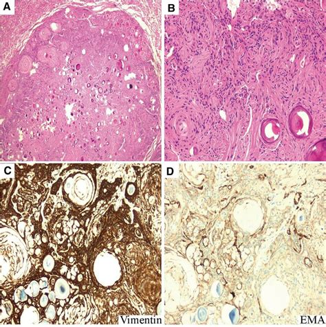 He And Immunohistochemical Staining Findings Of The Nodular Lesion On