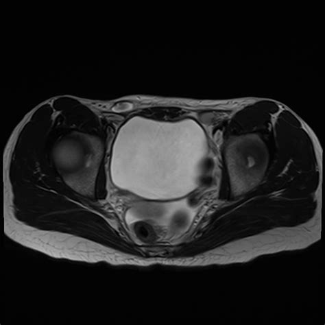 Testicular Feminization Syndrome Image