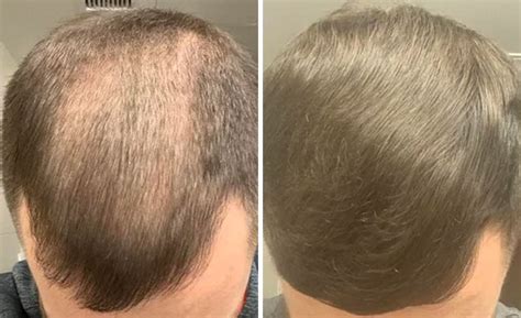 People Who Tried Out Hair Loss Treatments Are Sharing Their Results In