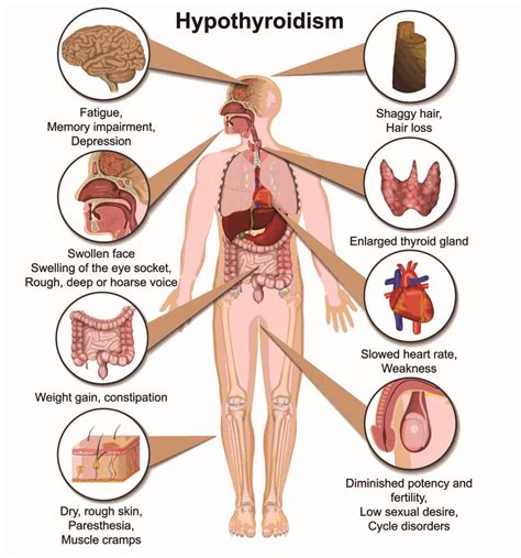 Hypothyroidism Causes Symptoms Diagnosis And Treatment Ck Birla
