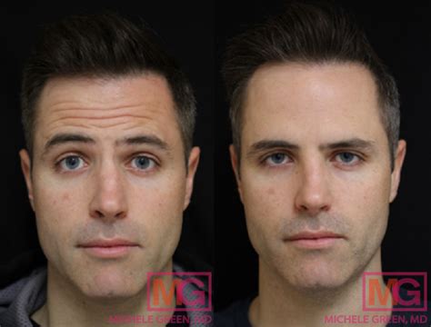 Botox Men