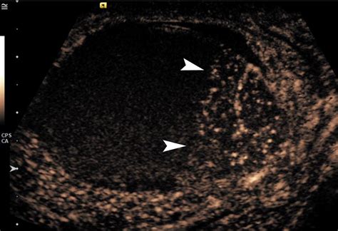 Segmental Testicular Infarction Pacs