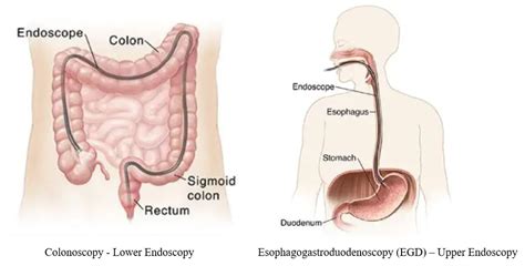 Image result for Endoscopy Small Intestine