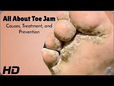Image result for Toe Jam Build Up