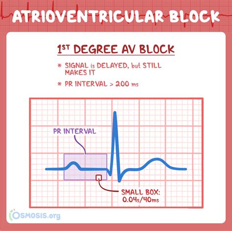 Image result for AV Block PR Interval
