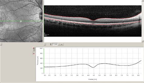 Image result for Oct Retinal Scan