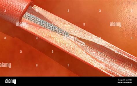 Image result for Heart Block Angiogram