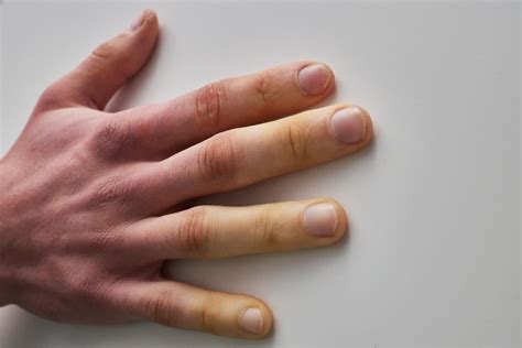 Image result for Scleroderma Skin