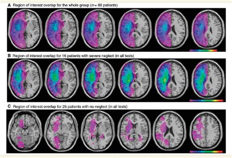Image result for Contralateral Neglect