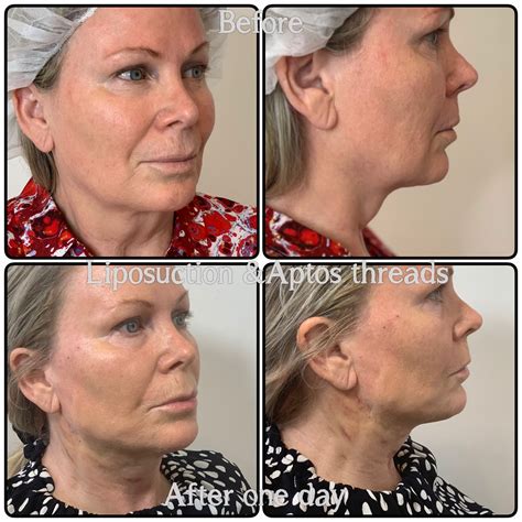 Image result for Back Neck Threading