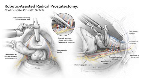 Image result for Simple vs Radical Prostatectomy