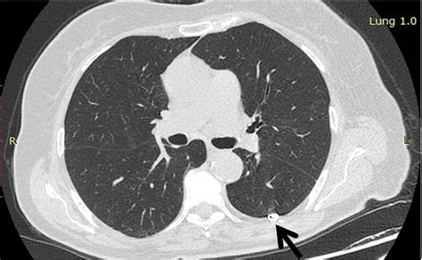 Image result for Loop Recorder Chest XR