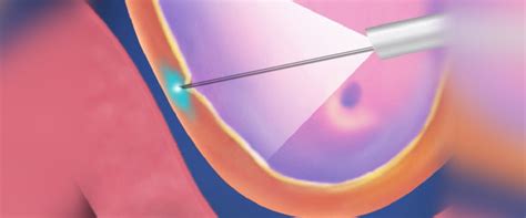 Image result for How Is Botox Injected into the Bladder