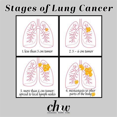 Image result for How Fast Can Lung Cancer Develop