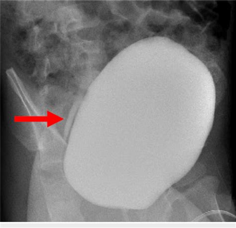 Image result for Cystourethrogram