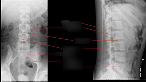 Image result for Sharp Slender Process