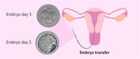 Image result for Watch Embryo Transfer