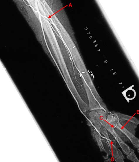 Image result for Hand Angiogram