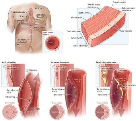 Image result for Type 2 Aortic Dissection