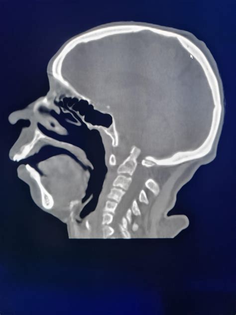 Image result for X-Rays for Basilar Invagination