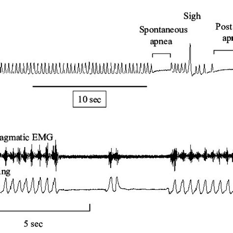 Image result for Apneustic Breathing Example