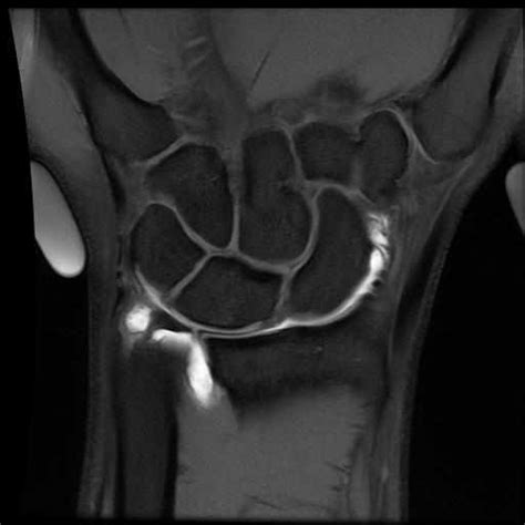 Image result for Wrist Arthrogram