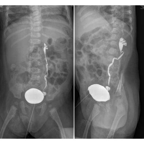 Image result for Cystourethrogram