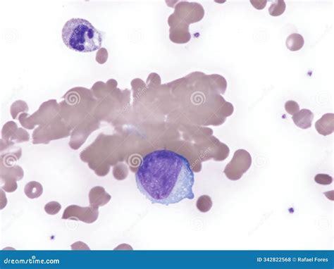 Image result for Diffuse Large Cell Lymphoma