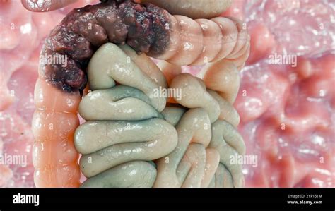 Image result for Colonoscopy Colon Cancer Polyps