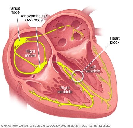 Image result for Incomplete Bundle Branch Block Left Treatment